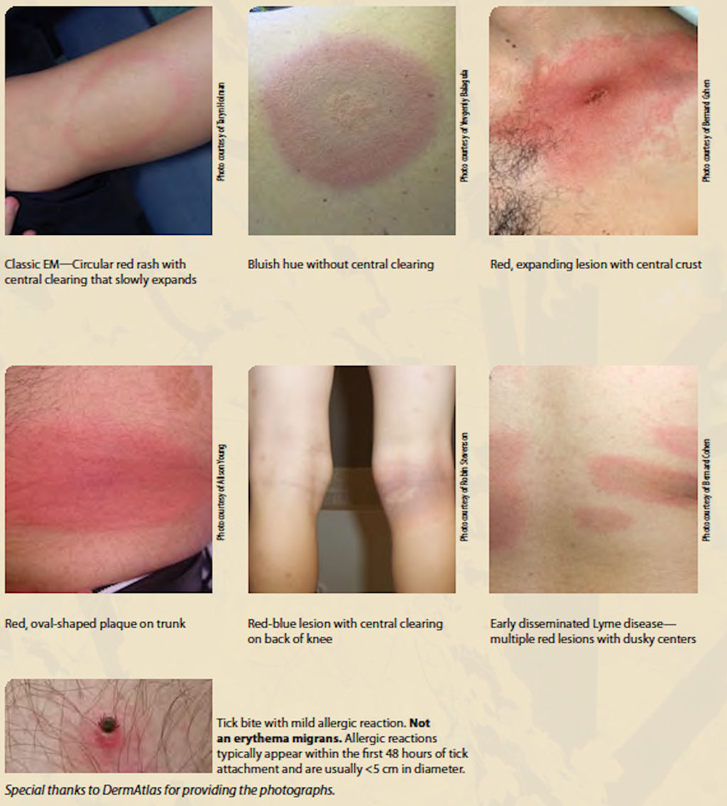 Know Your Rash – Wayne County Lyme Disease Task Force