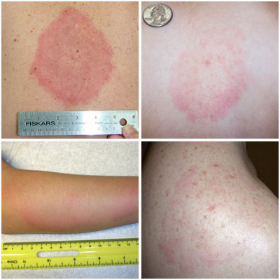 Know Your Rash – Wayne County Lyme Disease Task Force